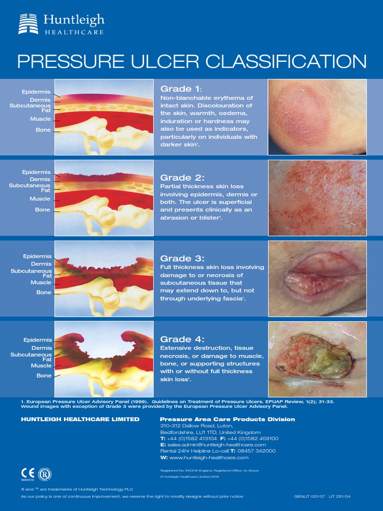 Arjo Pressure Ulcer Classification Guide | PDF