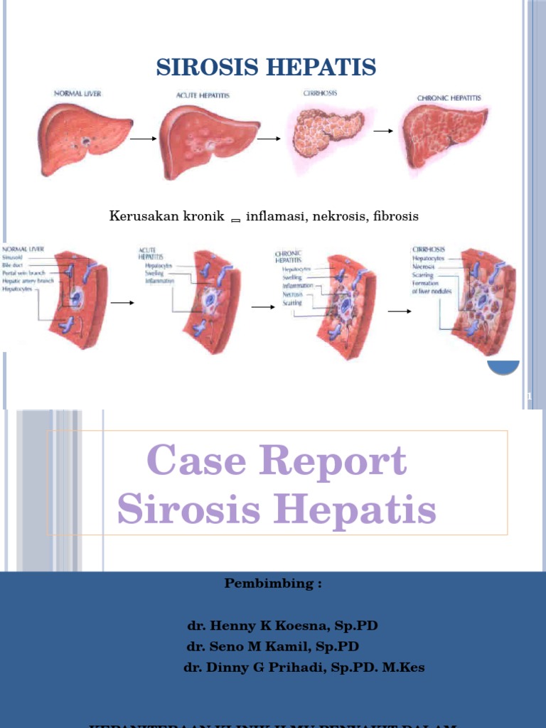 Sirosis Hepatis | PDF