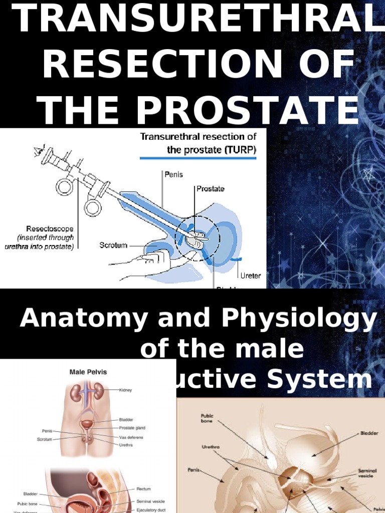 Transurethral Resection of The Prostate | PDF | Prostate | Surgery