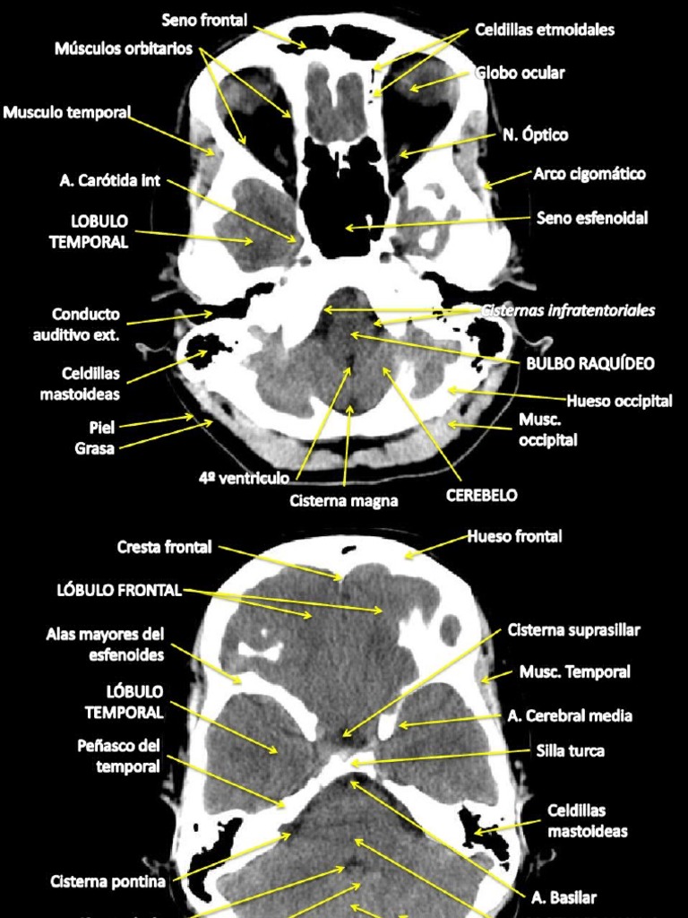 Anatomía Del Cráneo Por Tomografía Computarizada Tomografía