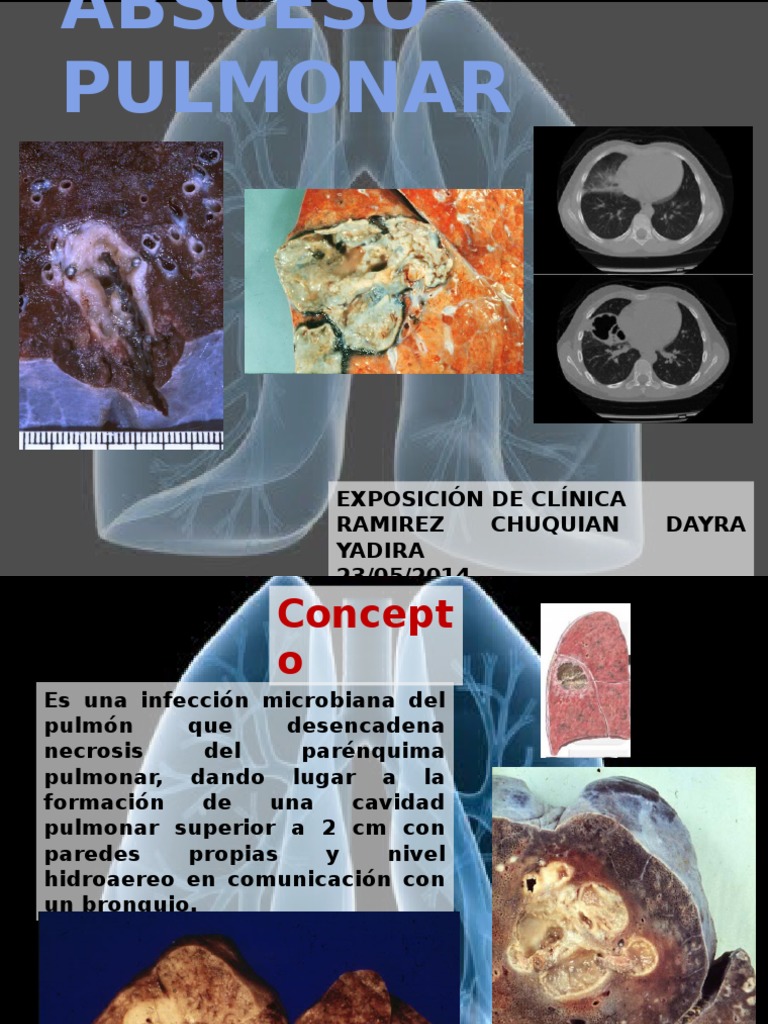 Absceso Pulmonar | PDF | Pulmón | Infección