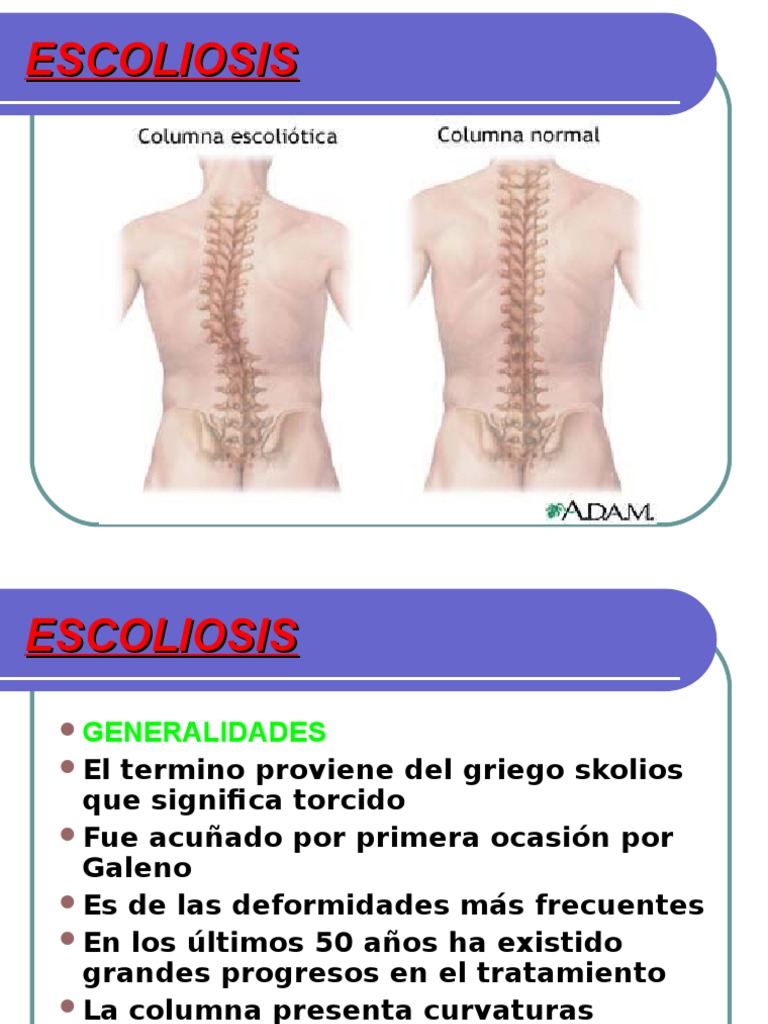 Escoliosis | PDF | Escoliosis | Medicina
