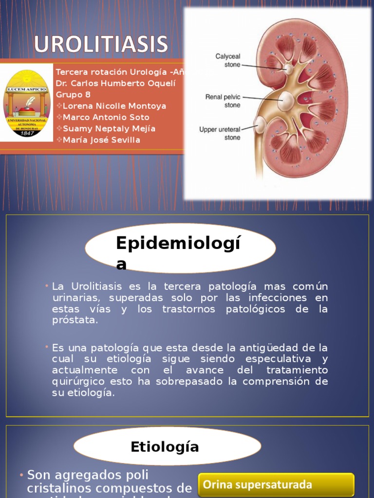 UROLITIASIS | PDF | Especialidades Medicas | Medicina CLINICA