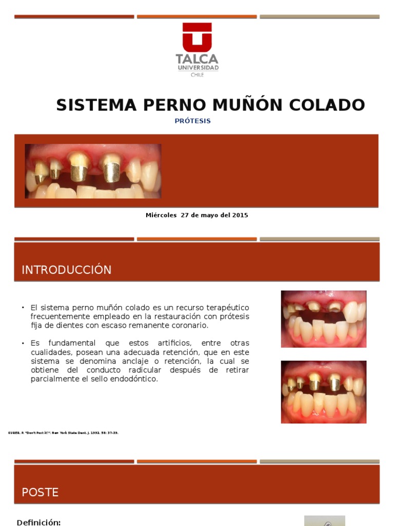 Perno Muñon Colado, Bipartito, Transfixiante | Diente humano ...