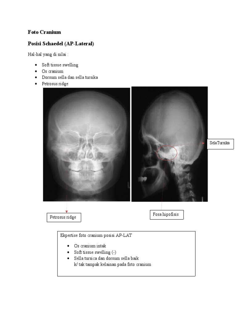 Foto Cranium Schaedel (AP-Lateral) | PDF