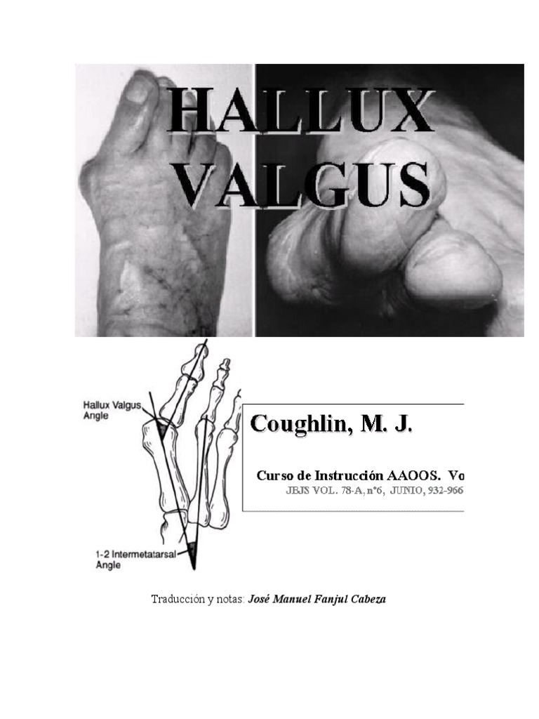 Hallux Valgus | Dedo | Extremidades (Anatomía)