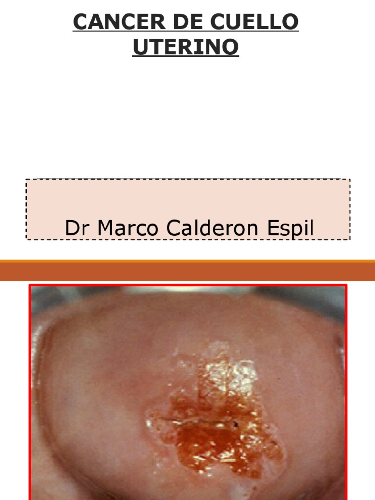 Cancer de Cervix | Cáncer de cuello uterino | Cáncer