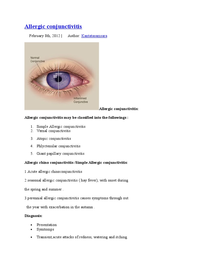 Allergic Conjunctivitis | Allergy | Rtt