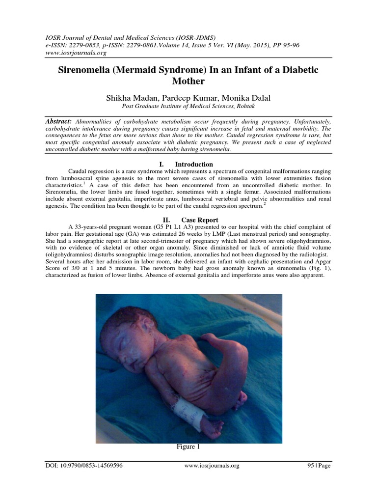 Sirenomelia (Mermaid Syndrome) In an Infant of a Diabetic Mother ...