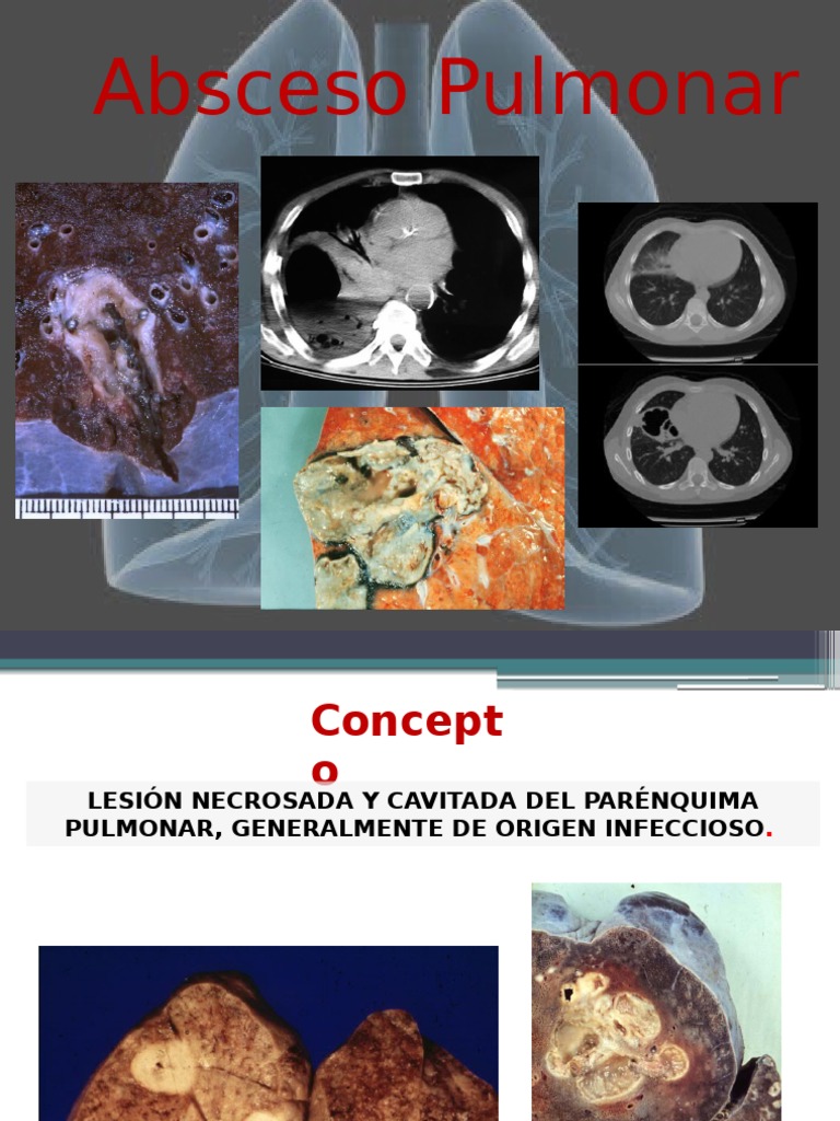 Absceso Pulmonar | Infección | Medicina