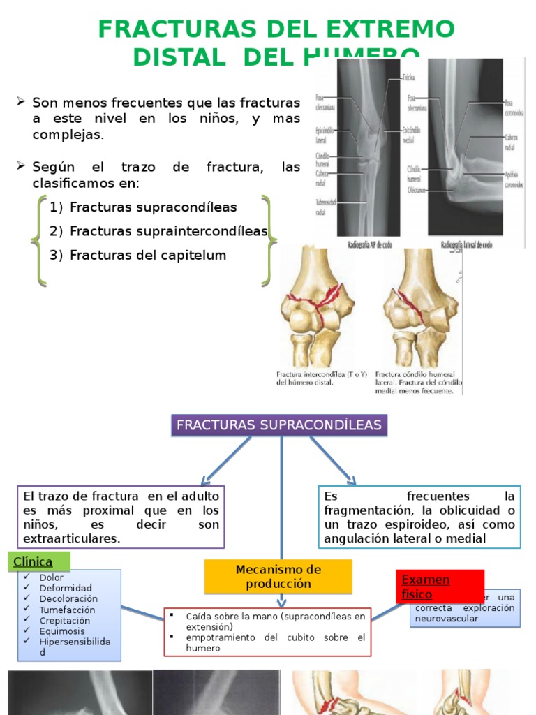 Fracturas de la extremidad distal del húmero: clasificación, mecanismos ...