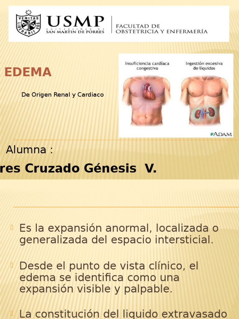 Expo EDEMA de Origen Cardiaco y Renal . | PDF | Edema | Especialidades ...