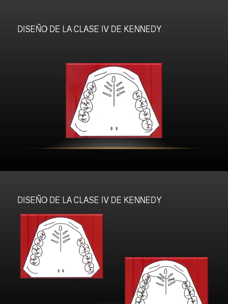 Diseño de La Clase IV de Kennedy | PDF