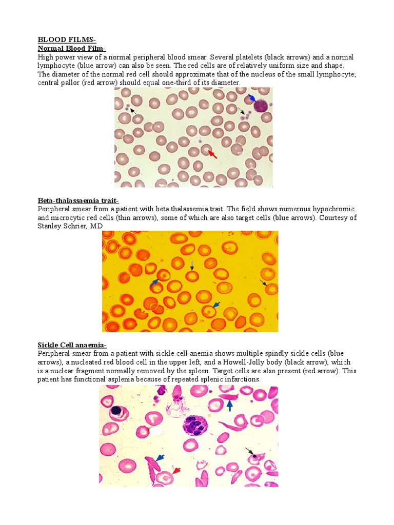 Haematology - Blood Films. | PDF | Anemia | Blood