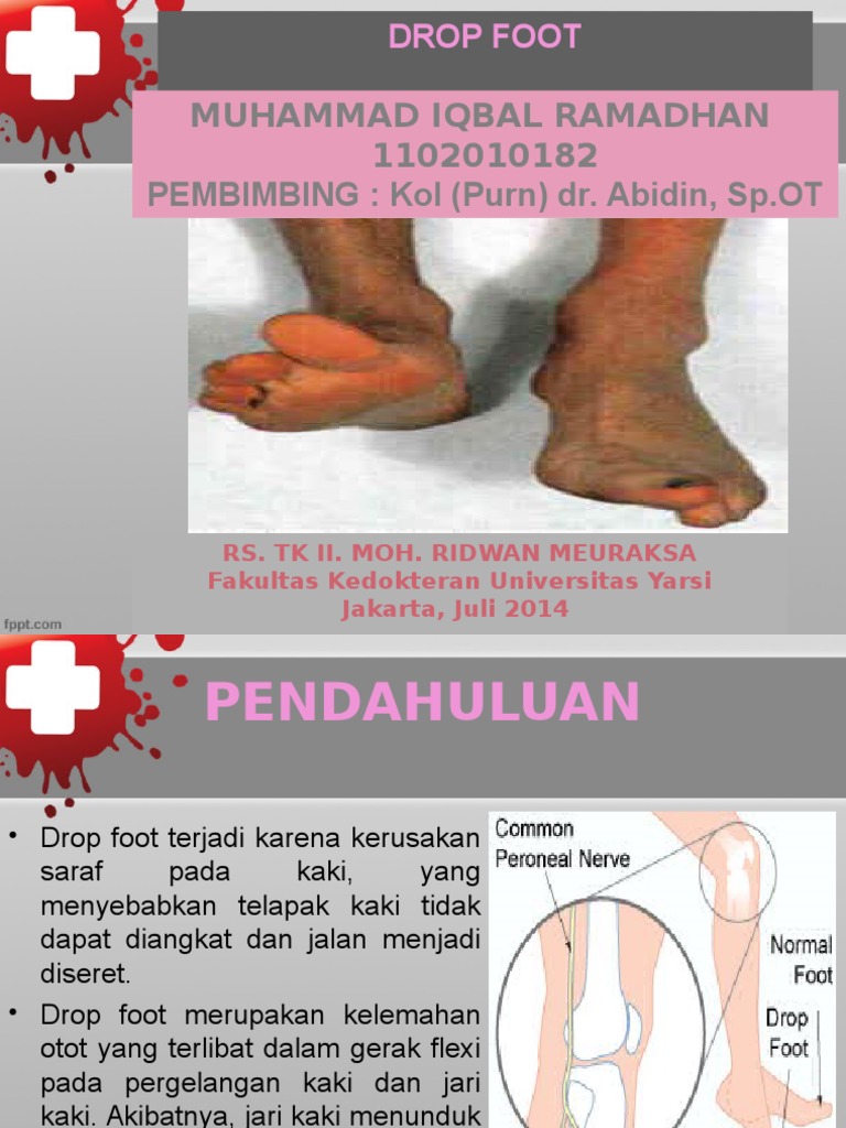 Penanganan dan Terapi Drop Foot | PDF | Sains & Matematika