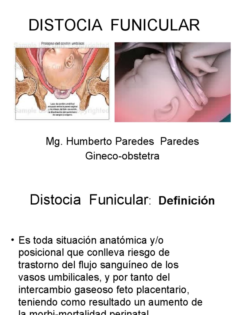 Distocia Funicular: Definición y Evaluación | PDF | Parto | Feto