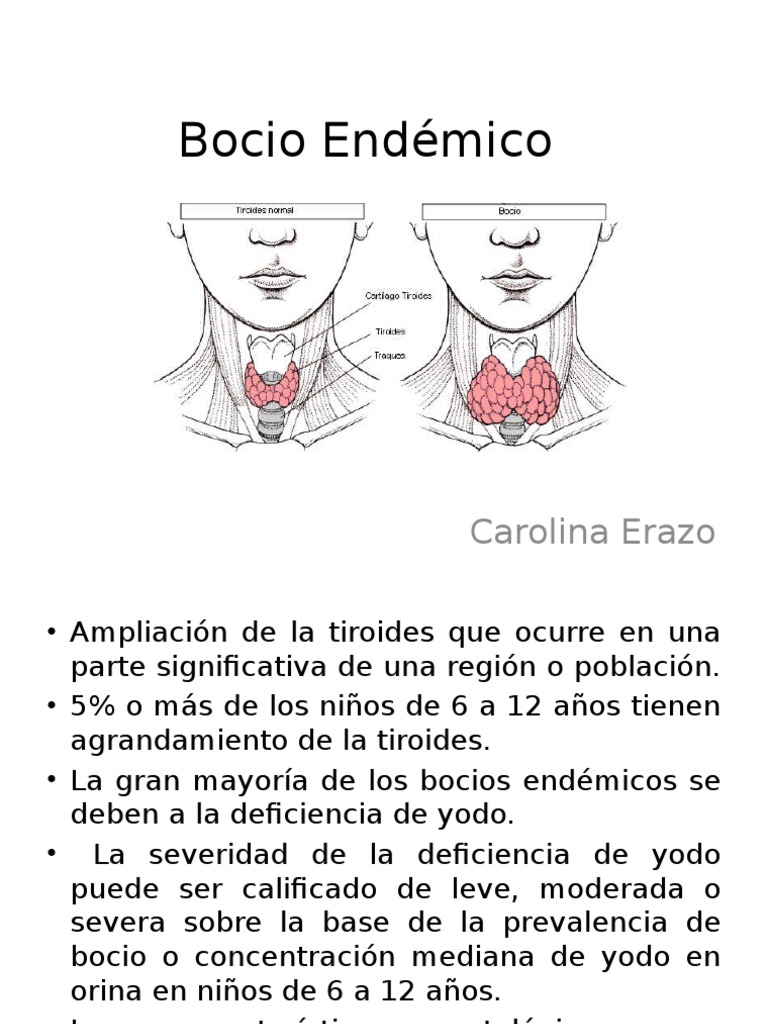 Bocio Endémico | Tiroides | Hormona estimulante de la tiroides