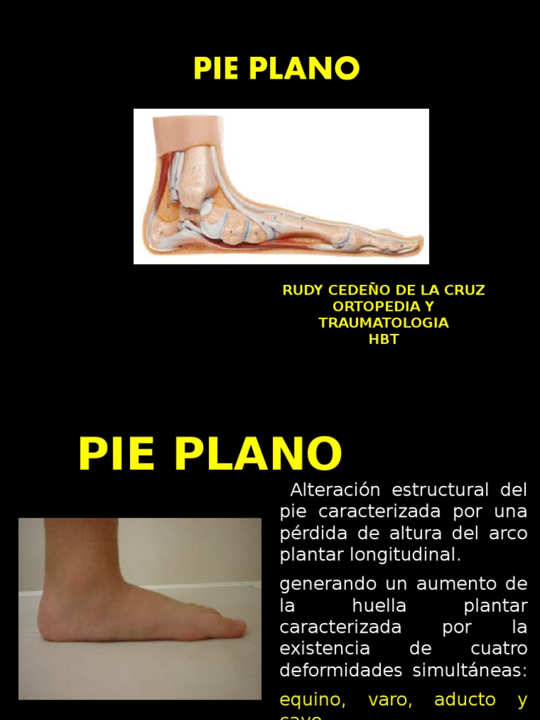 Pie Plano | PDF | Pie | Rodilla