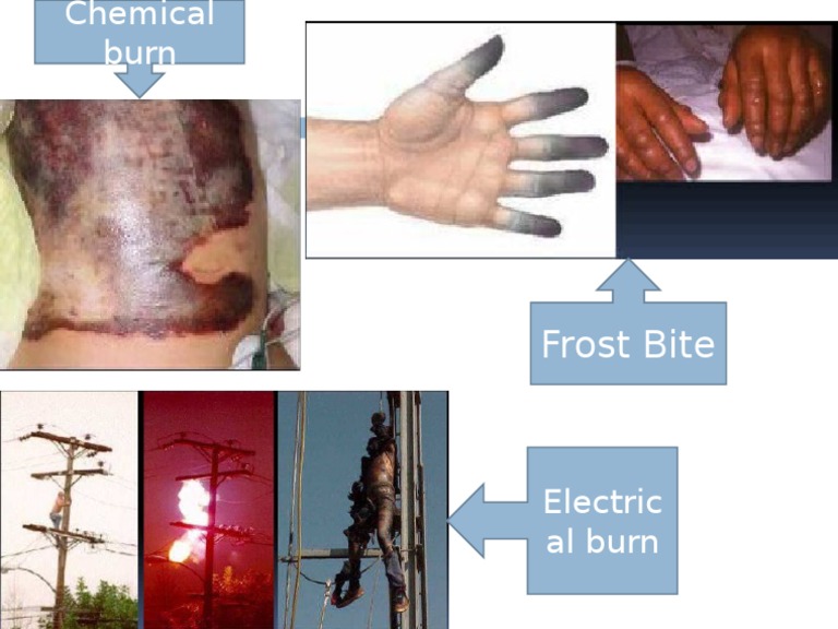 Frost Bite | PDF