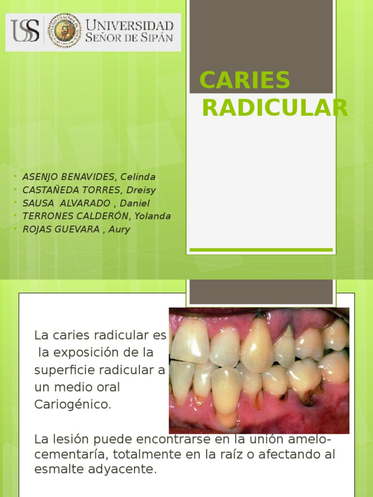 CARIES-RADICULAR-2 Expo | PDF | Diente humano | Odontología