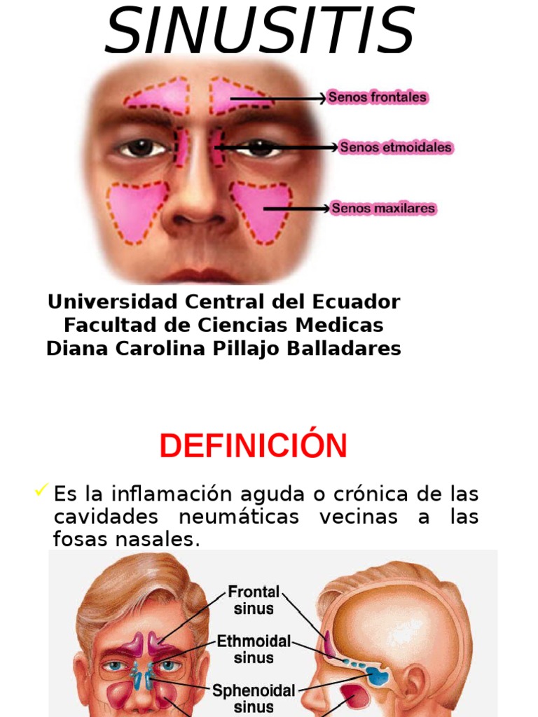 Sinusitis | PDF | Cabeza y cuello humanos | Sistema respiratorio