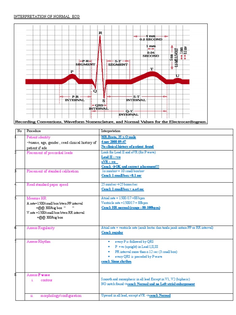Interpretation of Normal Ecg | PDF | Electrocardiography | Medical ...