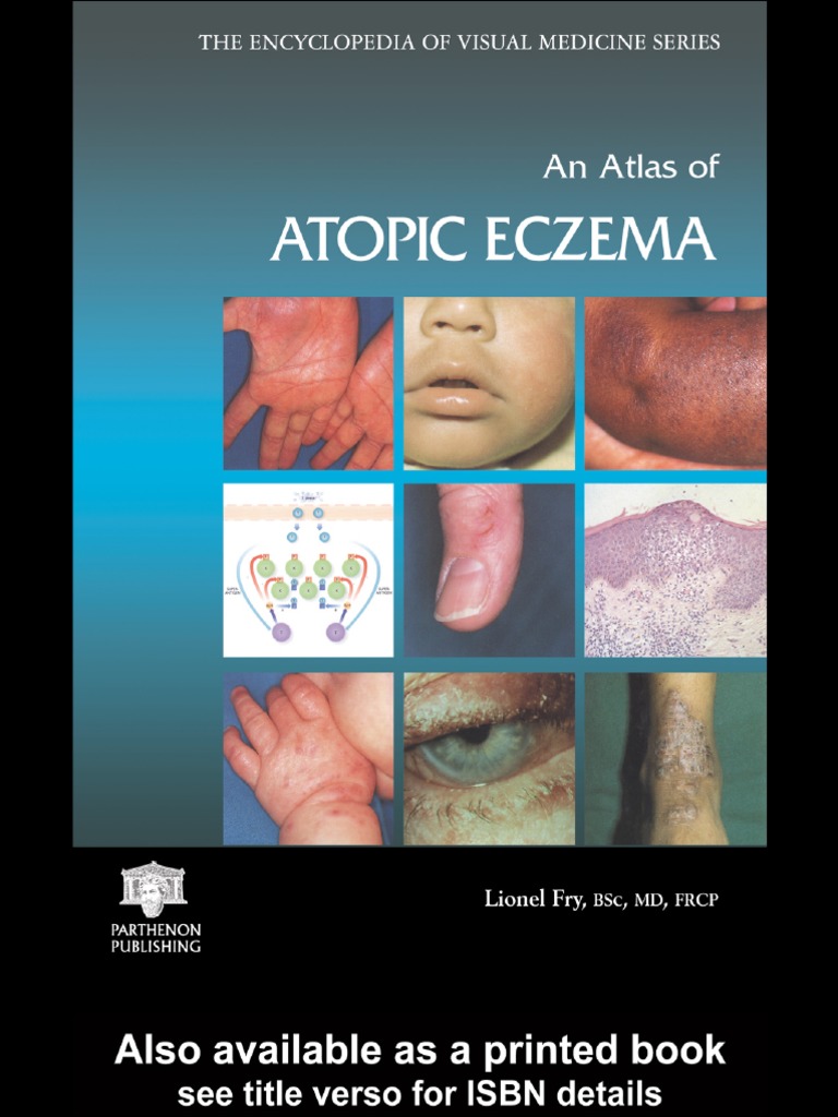 An Atlas Of Atopic Eczema Encyclopedia Of Visual Medicine Series Pdf Pdf T Helper Cell