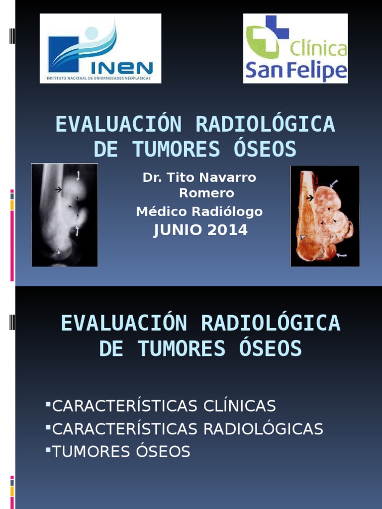 Tumores Oseos | PDF | Hueso | Neoplasias