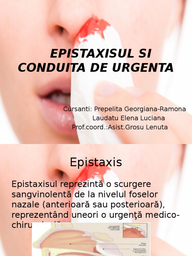 Epistaxis | PDF