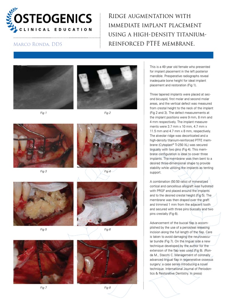 Ridge Augmentation With Immediate Implant Placement Using A High ...