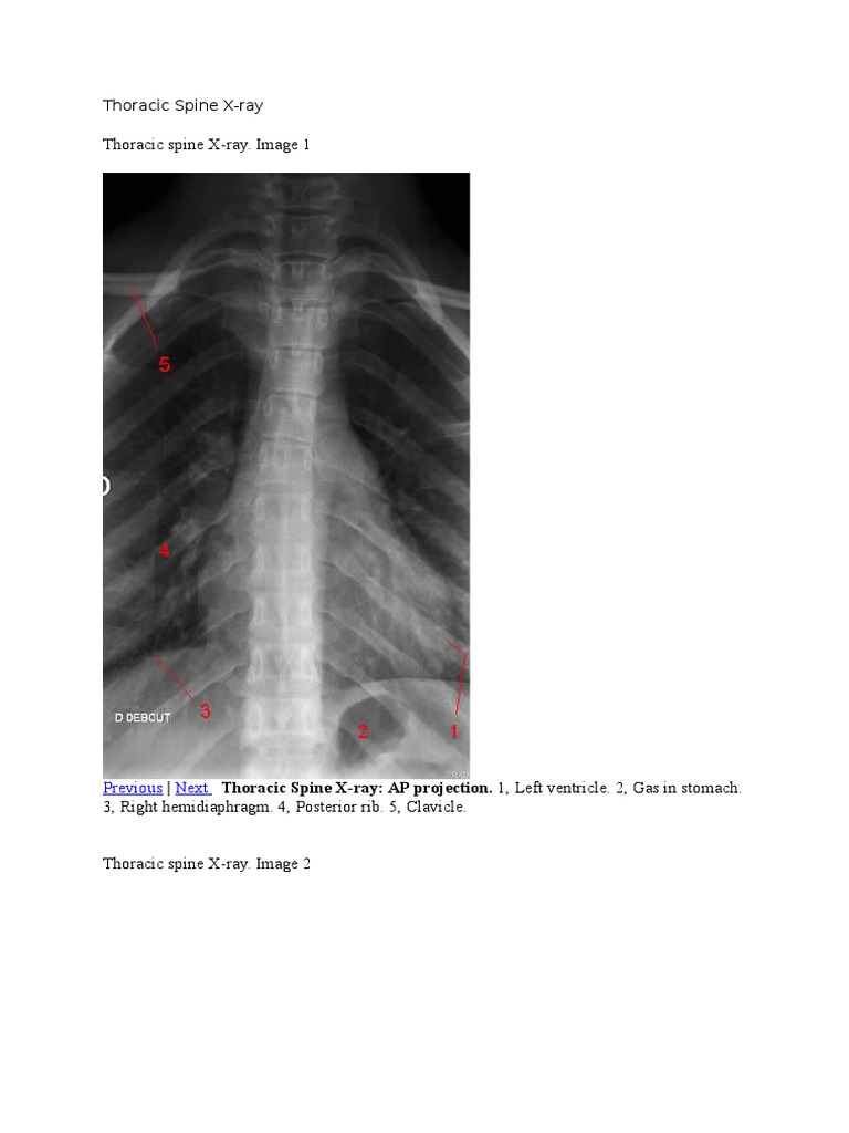 Thoracic Spine X-ray Overview | PDF