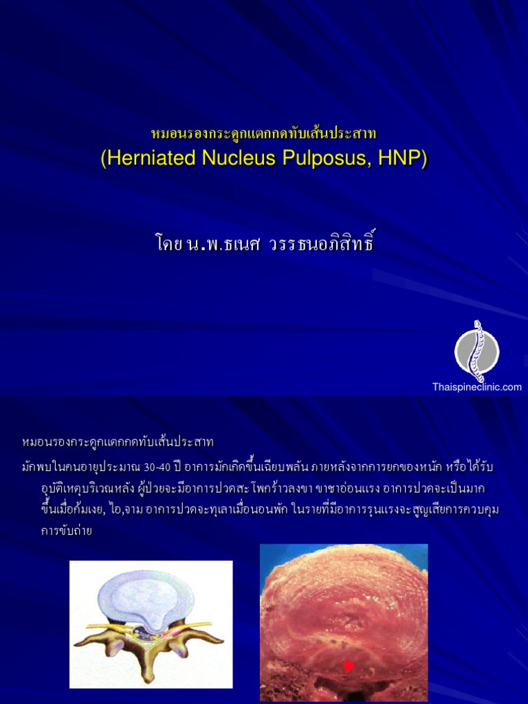 Herniated Nucleus Pulposus