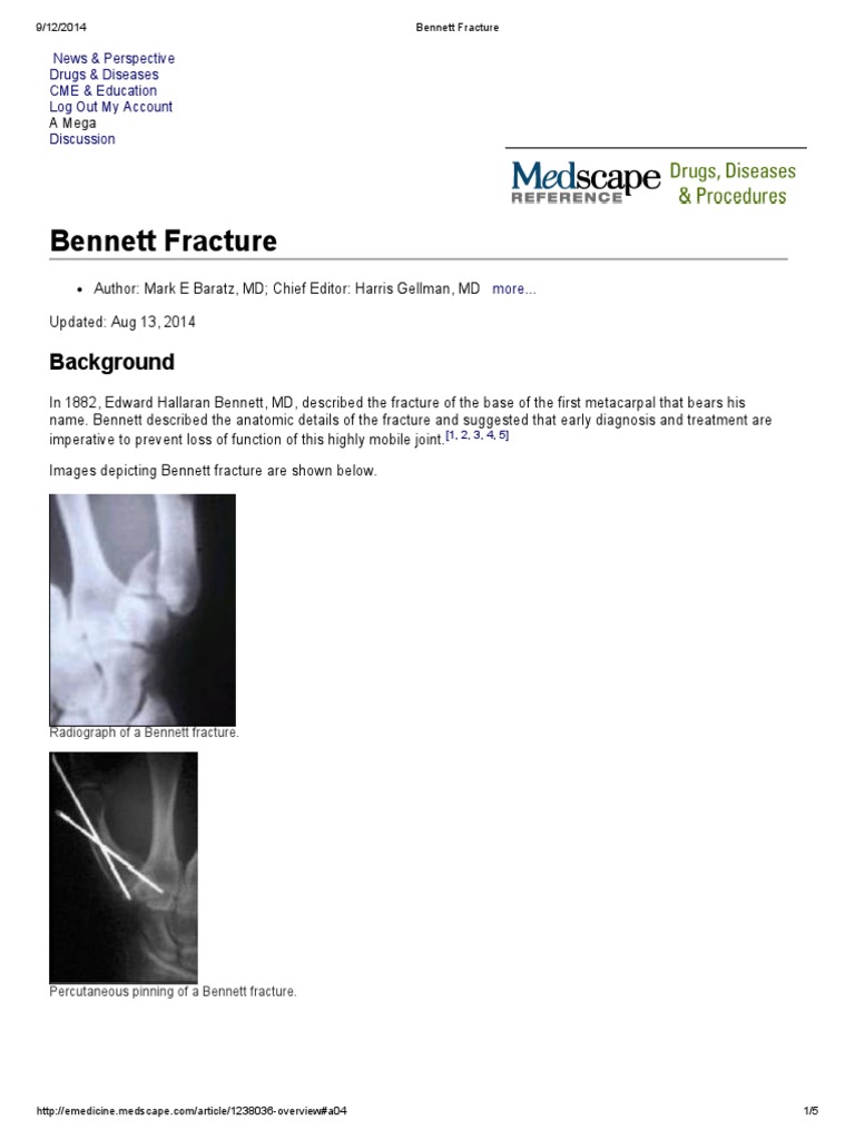 Bennett Fracture | Thumb | Orthopedic Surgery