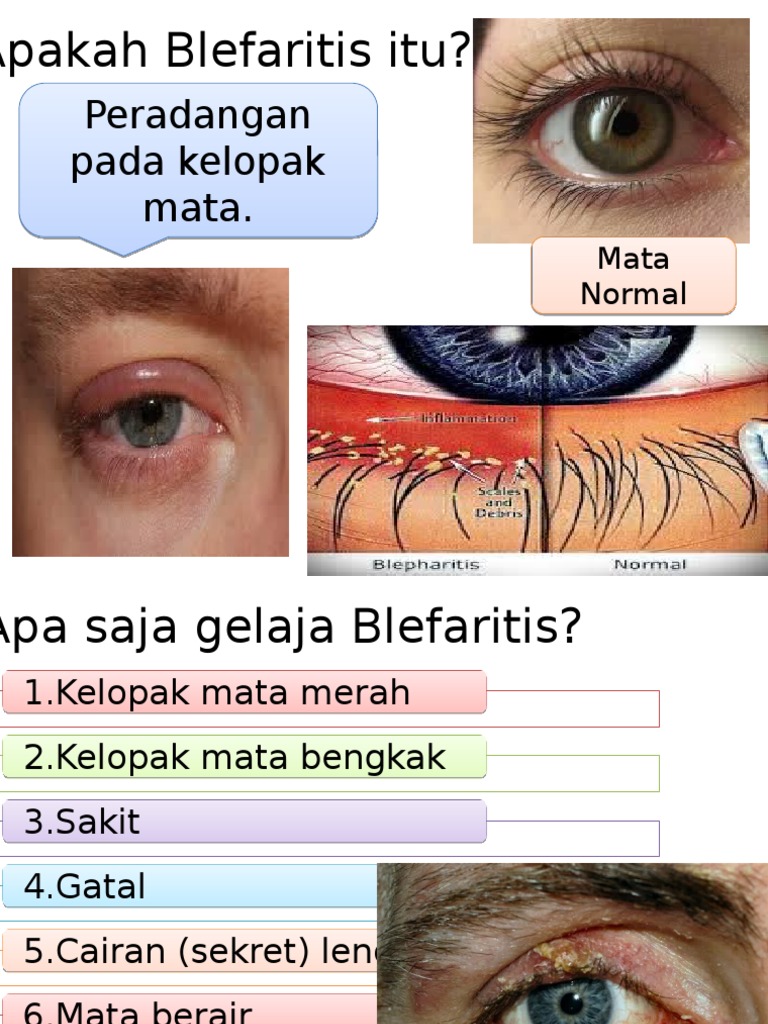 Panduan Singkat Blefaritis | PDF