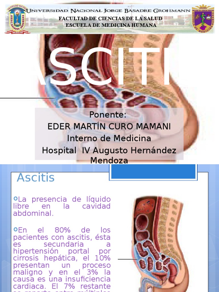 ASCITIS | Cirrosis | Medicina