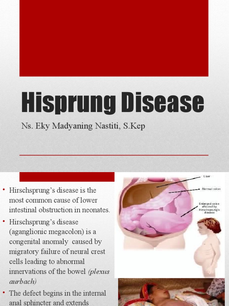 Hisprung Disease | PDF | Digestive System | Digestive Diseases