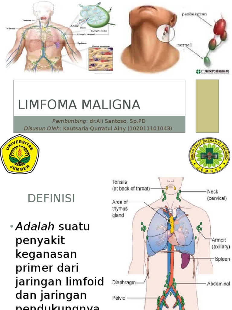 Limfoma Maligna | PDF