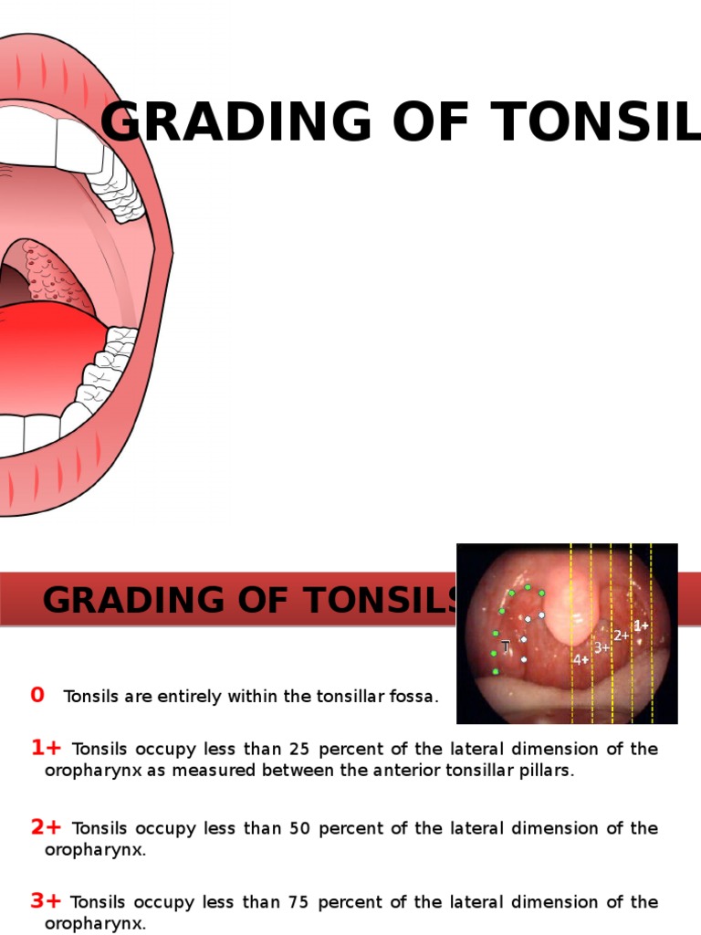 Tonsillitis Grading