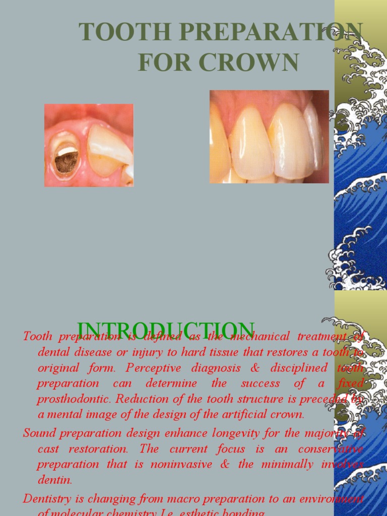 Crown Preparation Techniques Overview | PDF | Dentistry | Dentistry ...