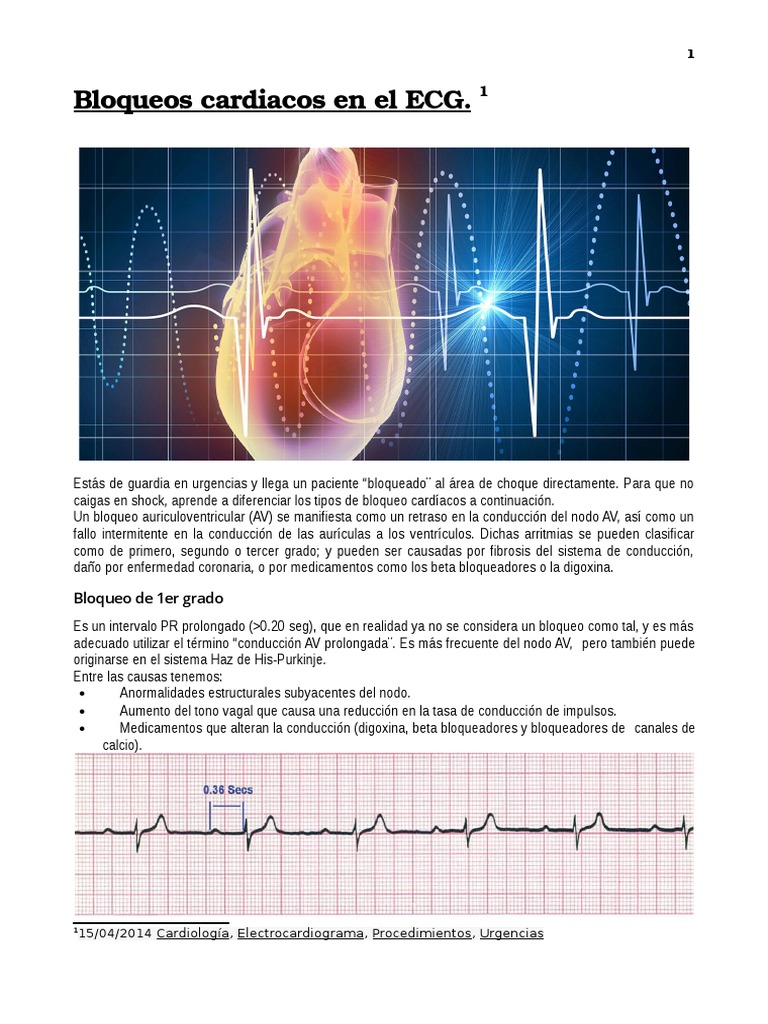 Bloqueos Cardiacos en El ECG | Arritmia cardiaca | Electrocardiografia