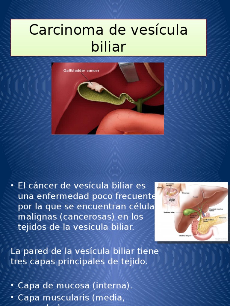 Carcinoma de Vesícula Biliar | Cáncer | Vesícula biliar