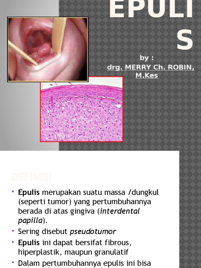 Epulis, Drg. Merry DMF 1 | PDF