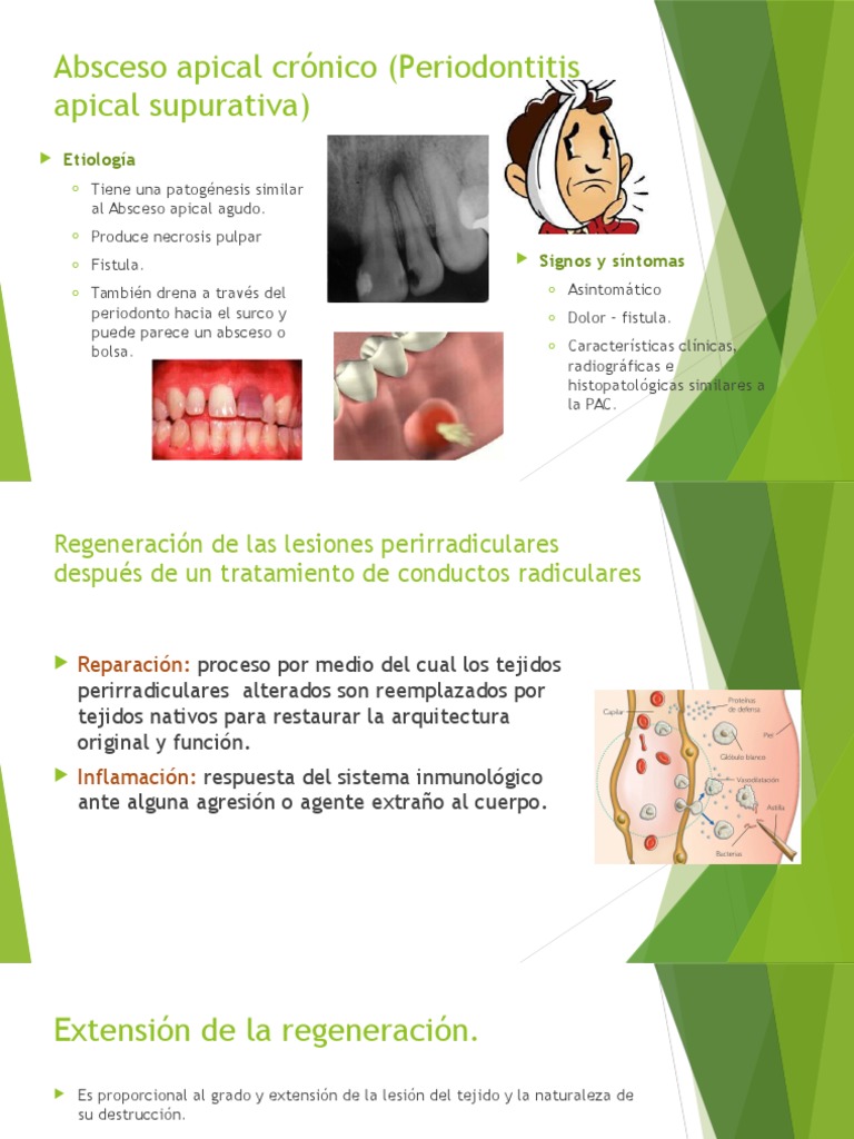 Absceso Apical Crónico (Periodontitis Apical Supurativa) | Diente ...