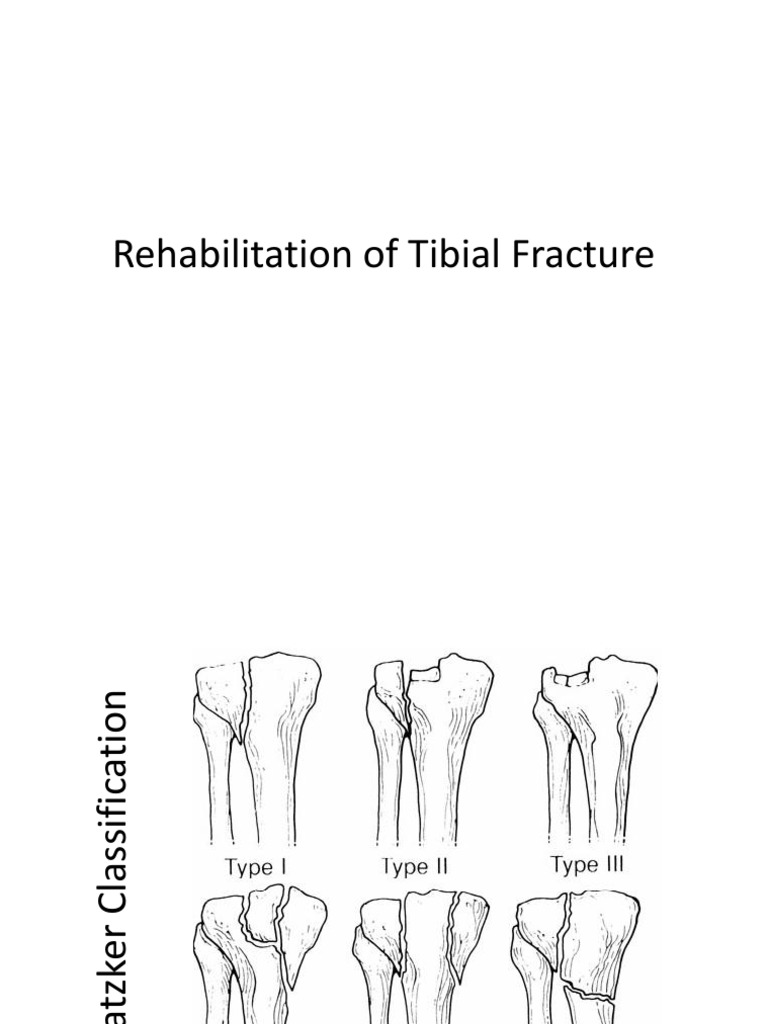 Rehabilitation of Tibial Plateau Fracture | PDF | Human Leg | Knee