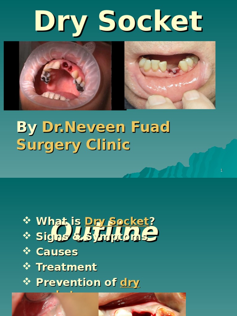 Understanding Dry Socket: Causes & Treatment | PDF