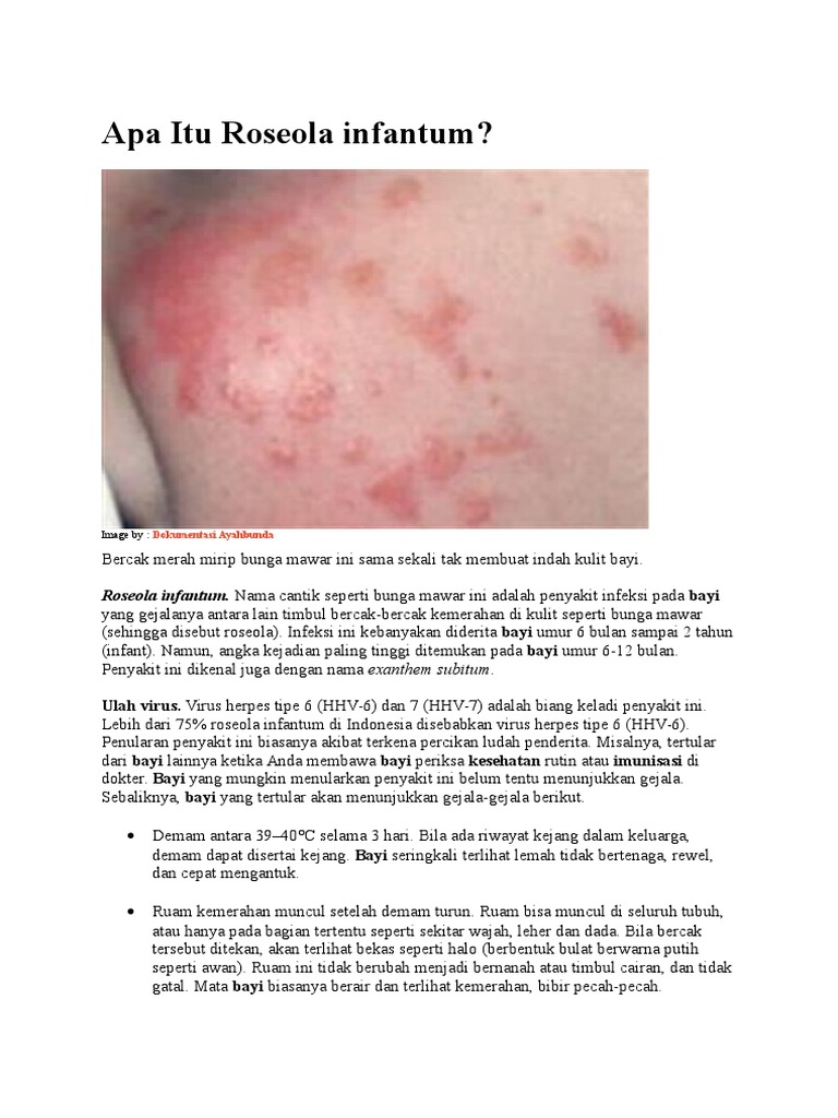 Apa Itu Roseola Infantum | PDF