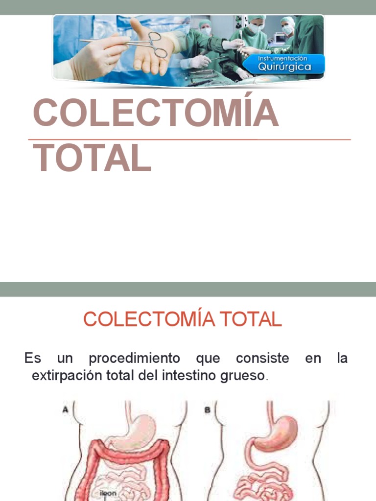 Colectomia Total | Intestino grueso | Enfermedad de Crohn