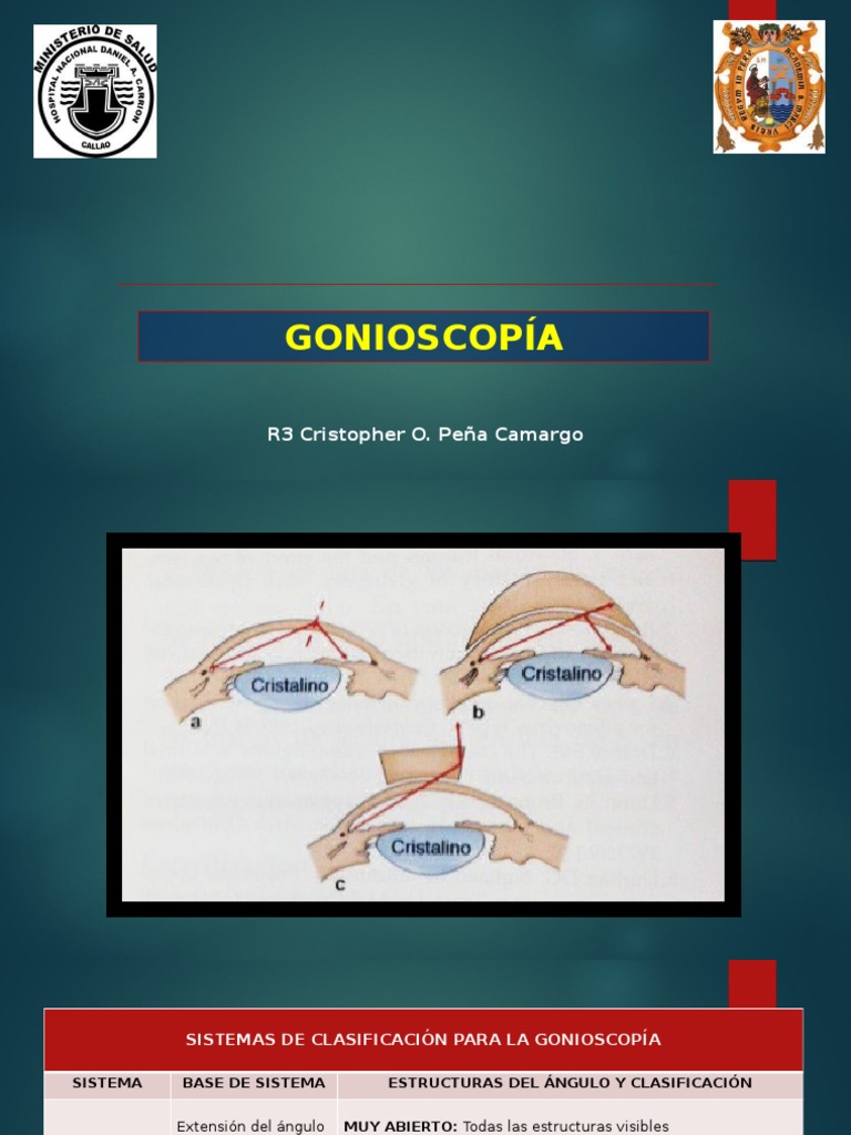 GONIOSCOPIA