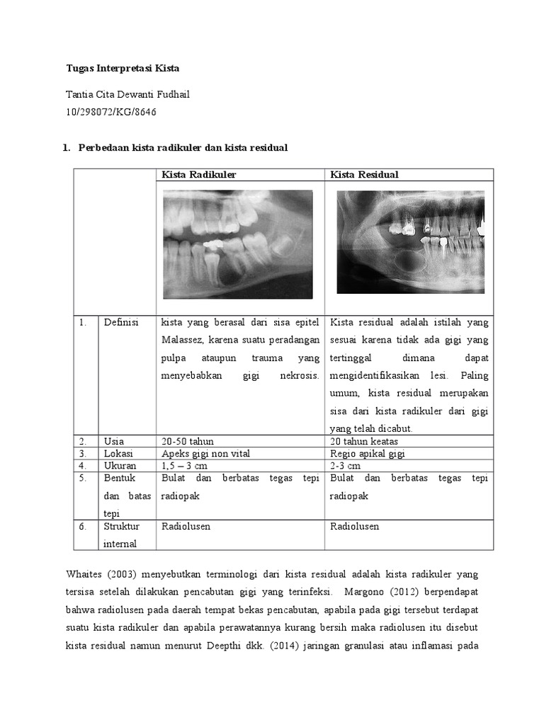 Interpretrasi Kista Radikuler | PDF