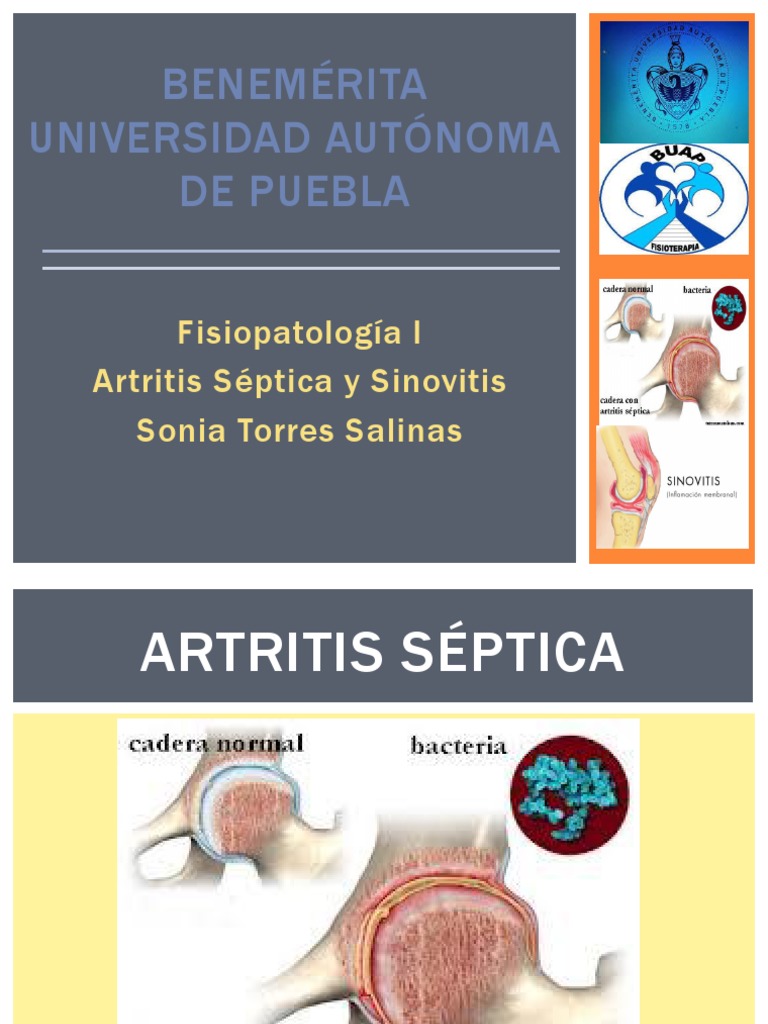 Artritis Septica y Sinovitis PDF | PDF | Rodilla | Artritis